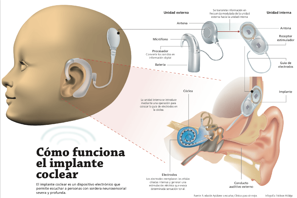Cuidados después de una cirugía de implante coclear en niños | Padres
