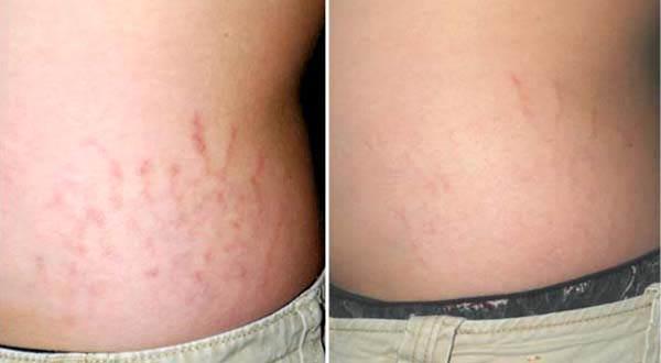 Cómo atenuar las estrías rojas con un tratamiento natural | Belleza