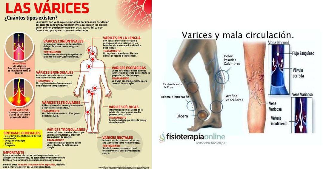 Varices: qué son, cómo prevenirlas y cómo tratarlas | Salud