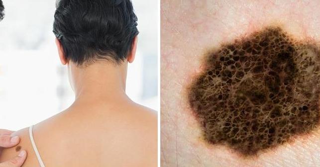 Tipos de manchas en la piel que necesitan atención: ¡alerta! | Salud